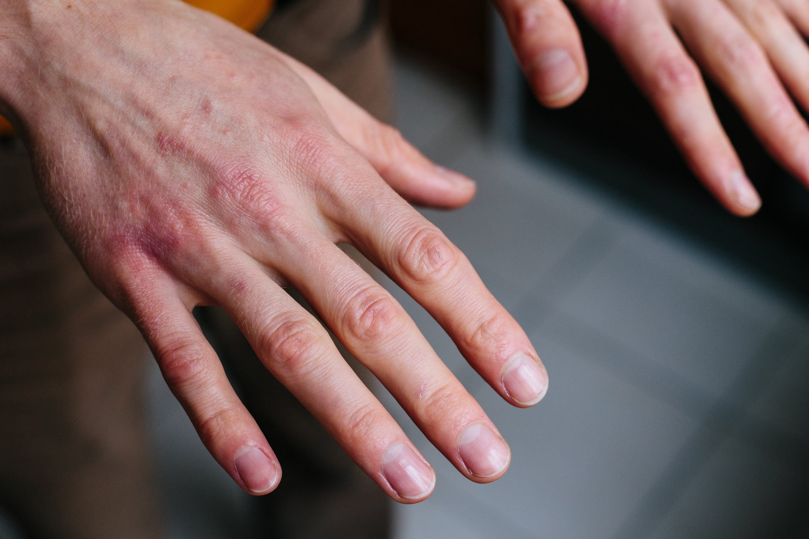 Cracked Hands & Feet Treatment for Sensitive Skin | CLMD Skin Care ...