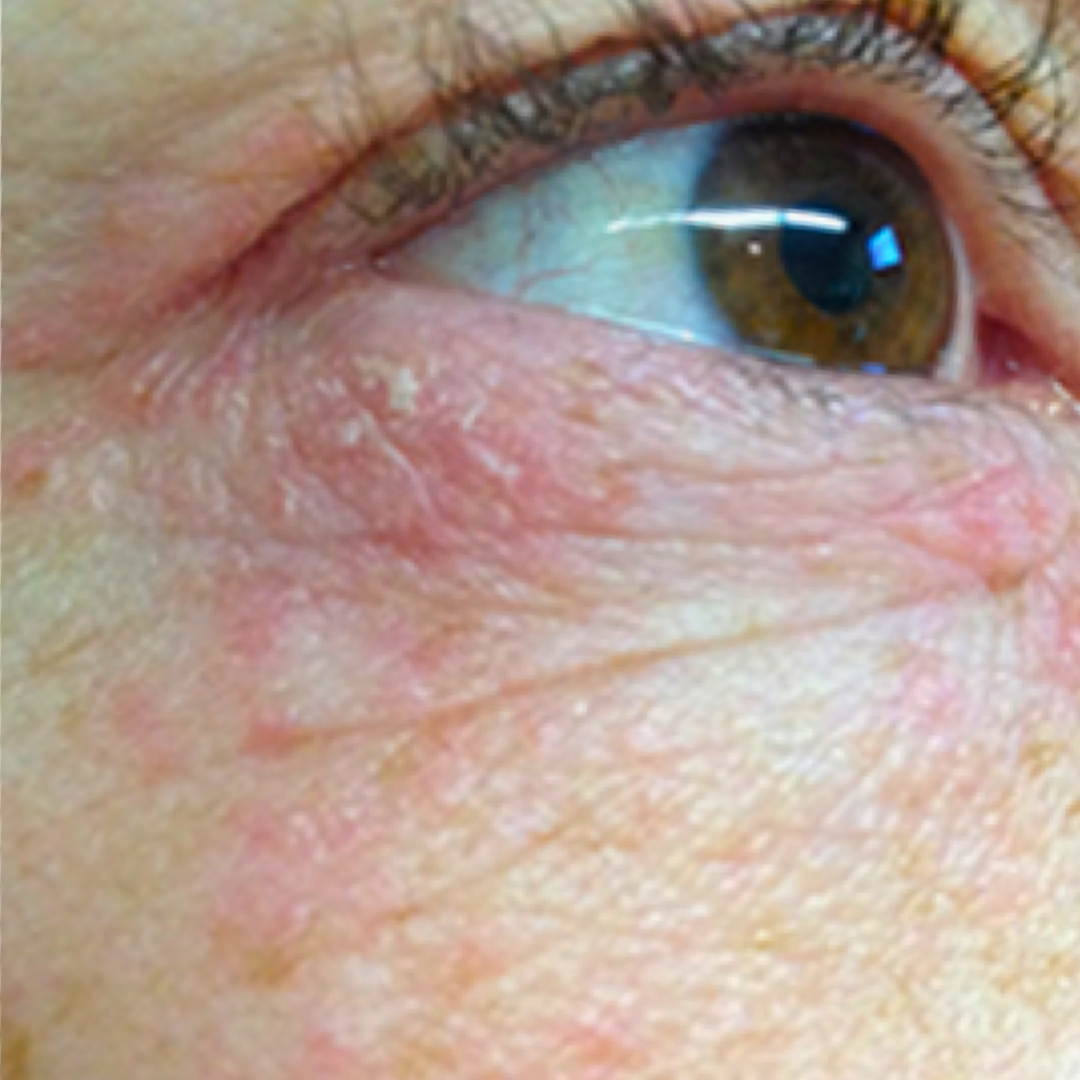 Perioral Dermatitis Treatment for Sensitive Skin | CLMD Skin Care ...