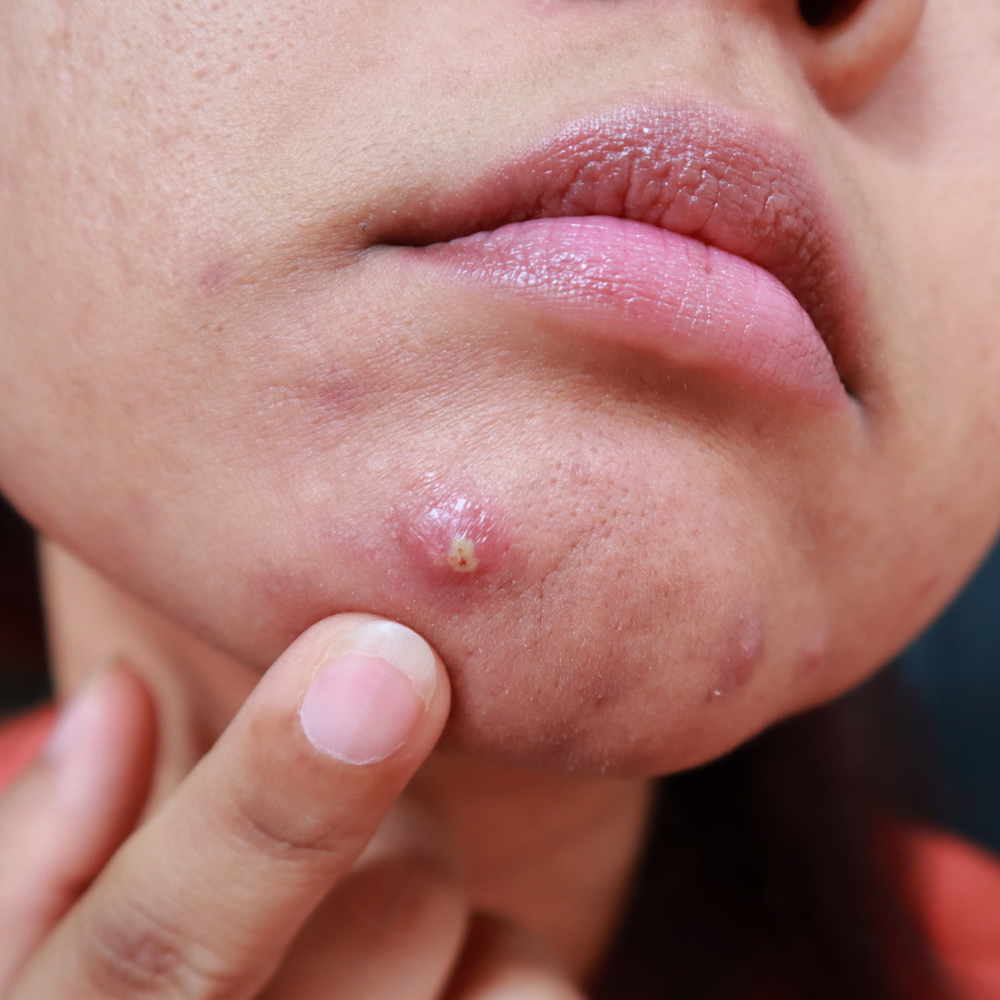 Acne Solution for Sensitive Skin | TrueLipids Acne Care by CLMD ...