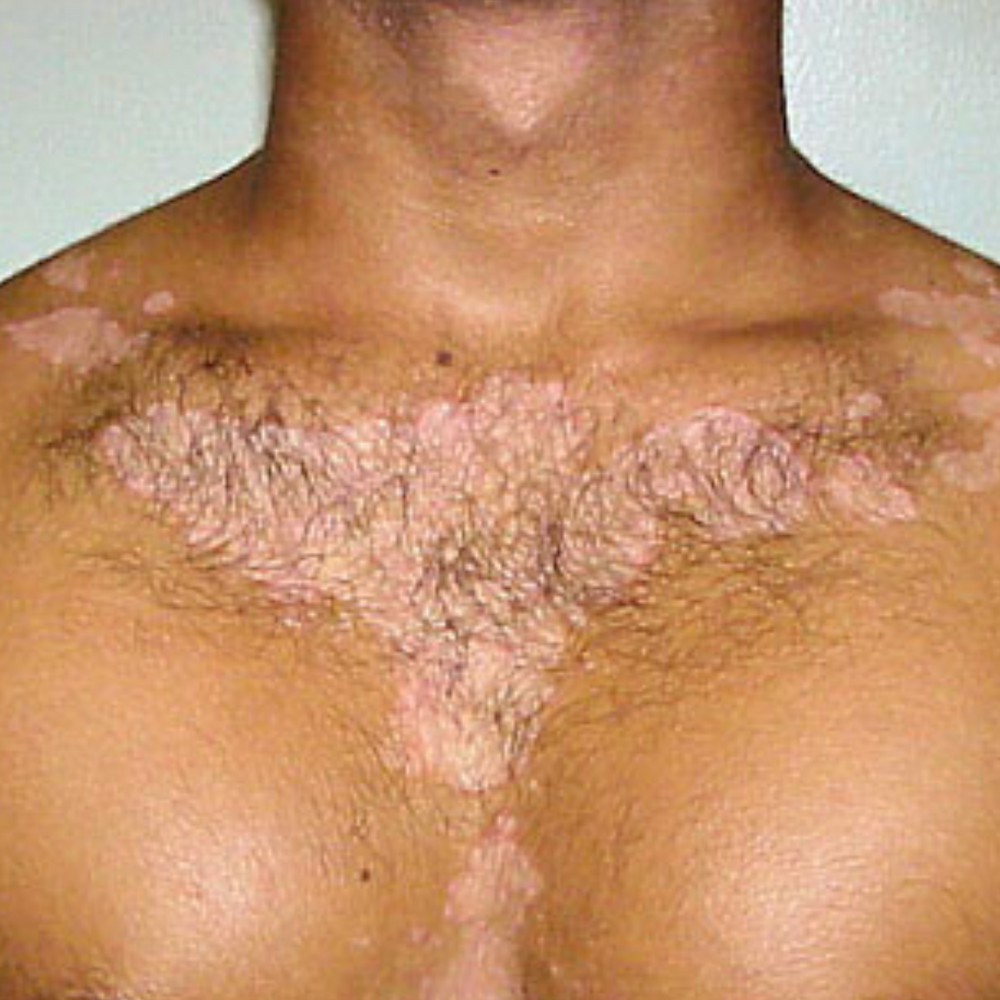 Seborrheic Dermatitis Treatment for Sensitive Skin | CLMD Skin Care ...